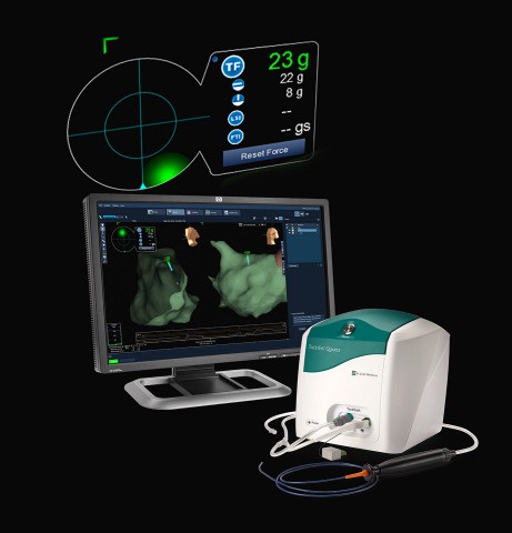 セント・ジュード・メディカル、心房細動の治療に使用するTactiCath Quartzコンタクトフォースアブレーションカテーテルを日本で上市 ...